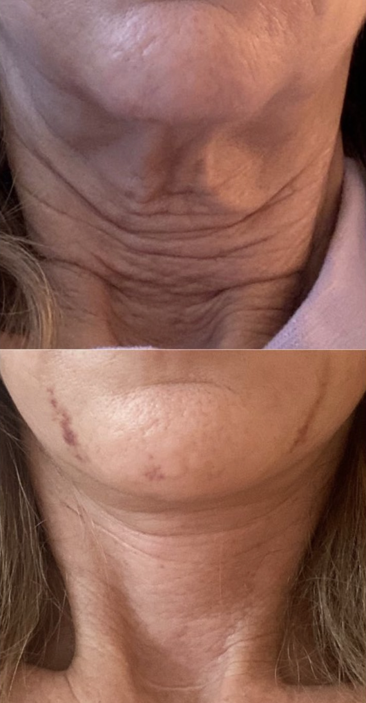 6 Maneras efectivas de tratar las arrugas del cuello
